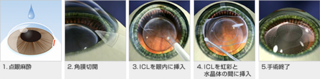 ICLについて | 金沢文庫アイクリニック